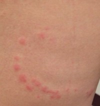 How To Recognise Bed Bug Bites? (on Black And White Skin) – Townhustle
