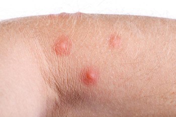 How To Recognise Bed Bug Bites? (on Black And White Skin) – Townhustle