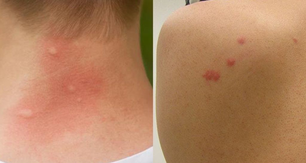 How To Recognise Bed Bug Bites? (on Black And White Skin) – Townhustle