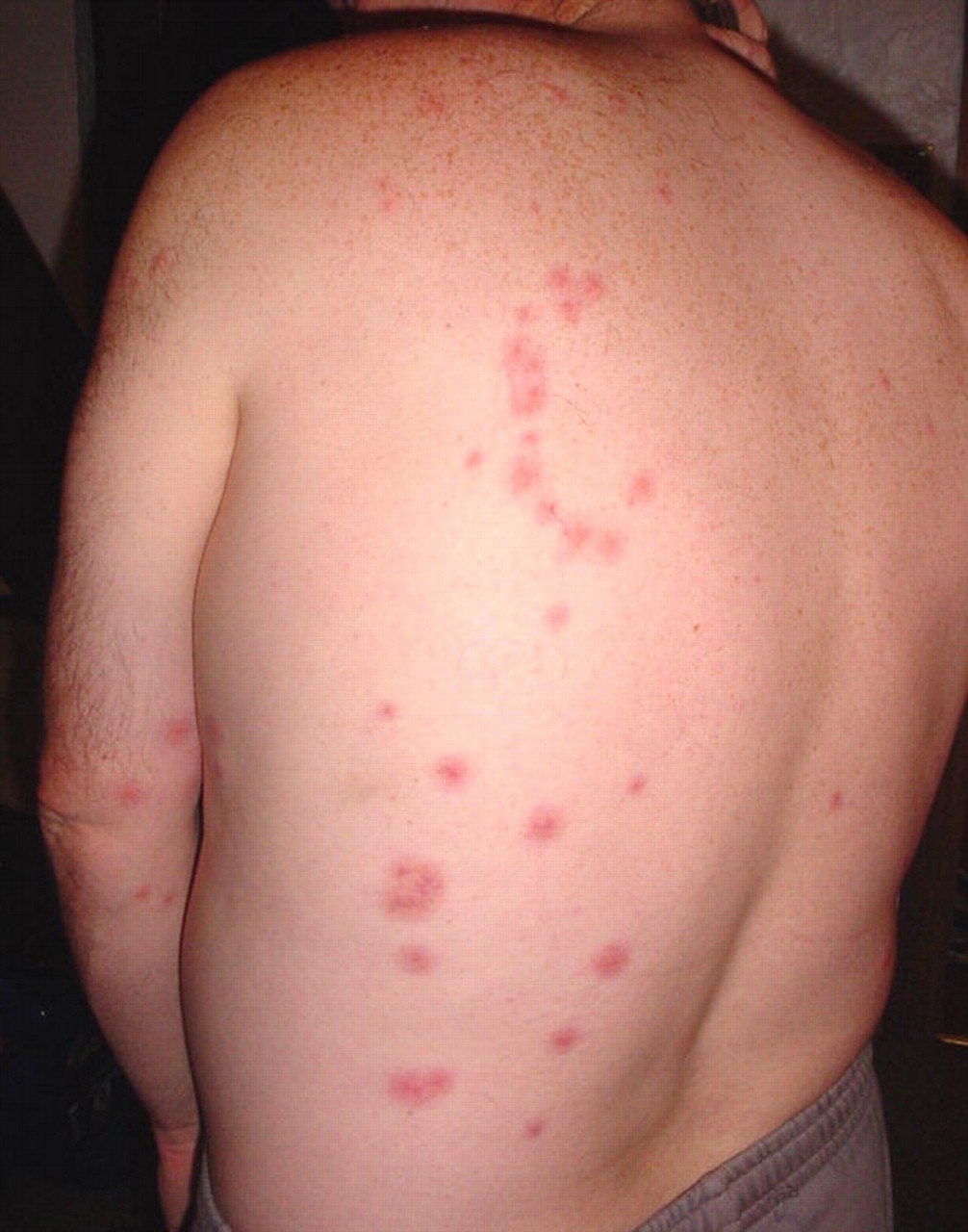 How To Recognise Bed Bug Bites? (on Black And White Skin) – Townhustle