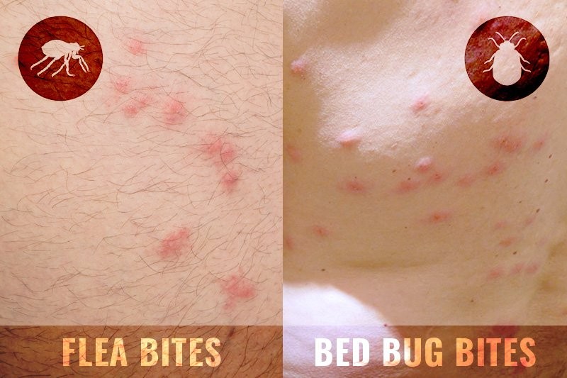 How To Recognise Bed Bug Bites? (on Black And White Skin) – Townhustle